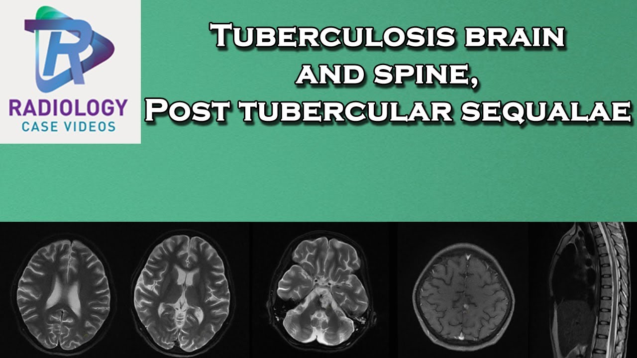 Tuberculosis brain and spine , Post tubercular sequalae - YouTube