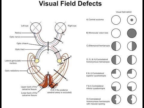 Visual field defect // Visual pathway lesions for MRCS - YouTube