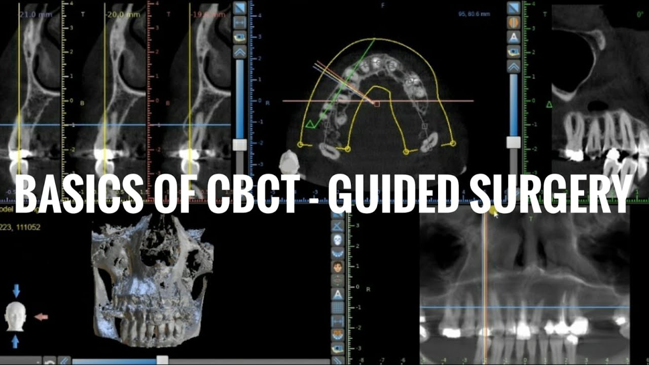 Basics Of CBCT - Guided Surgery Part 1 - YouTube