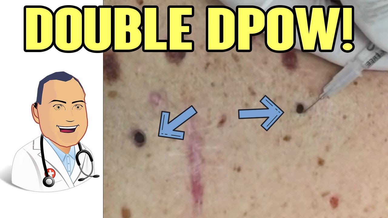 Oscar's Double DPOW Extractions - #9 Top Ten All Time - YouTube