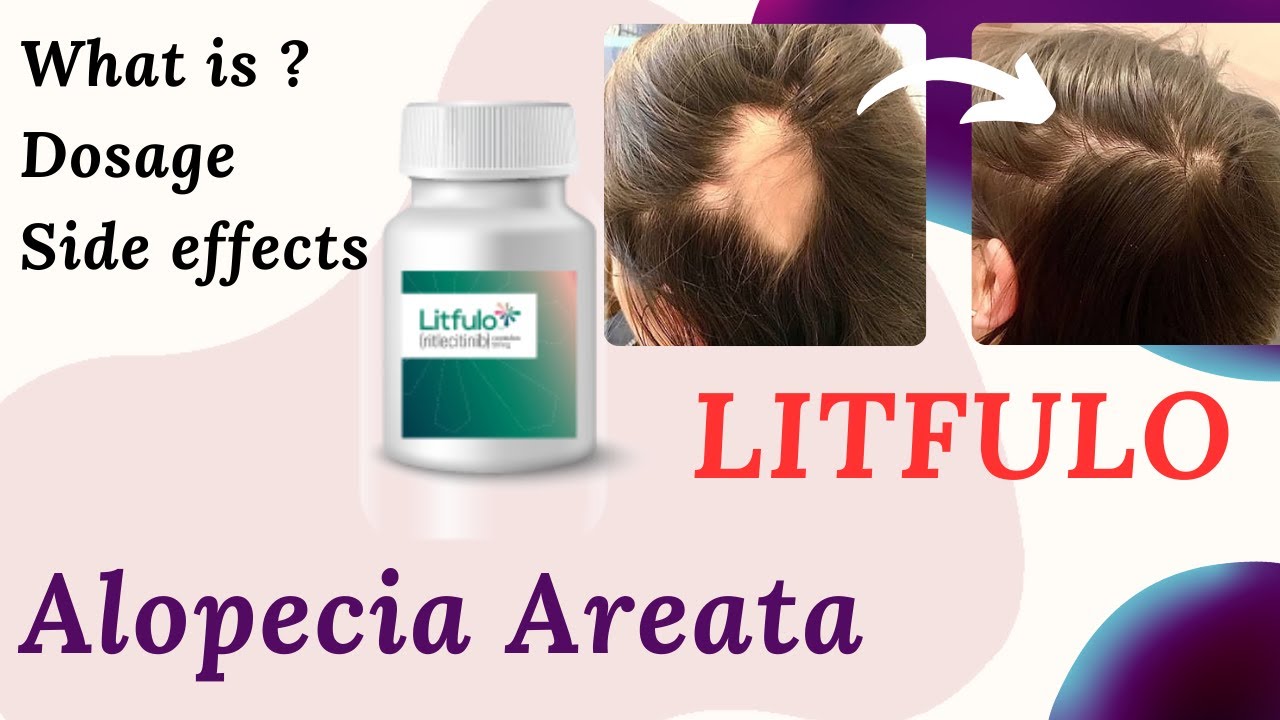 LITFULO: Alopecia Treatment Overview & Reviews | Pfizer's Breakthrough ...