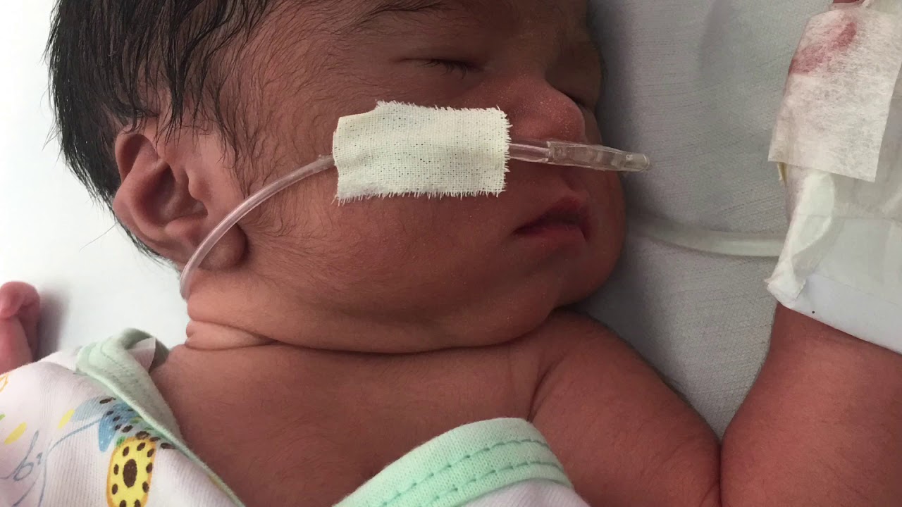 Filipino Indian Baby | was born at 35 weeks | premature | severe ...