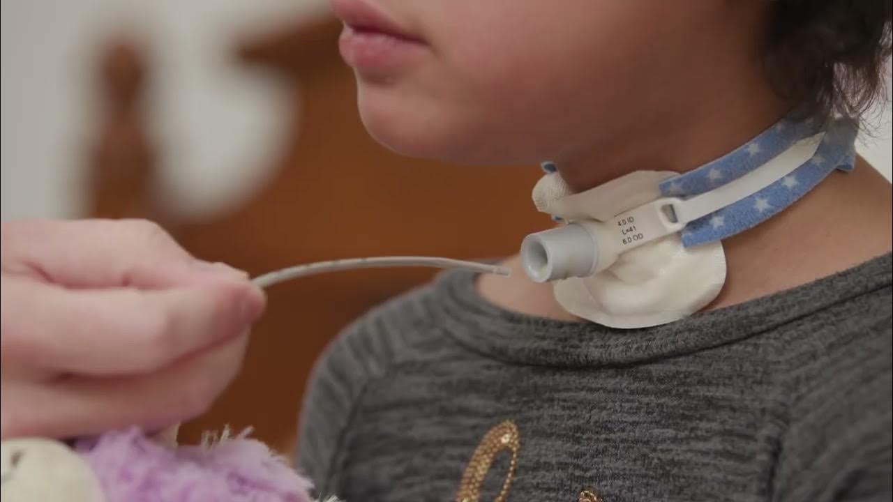 Open Suctioning With A Tracheostomy Tube At Home Youtube