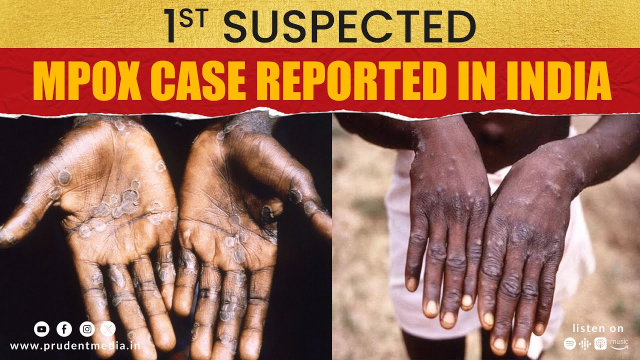 1st Suspected Case Of Monkeypox Reported In India - YouTube