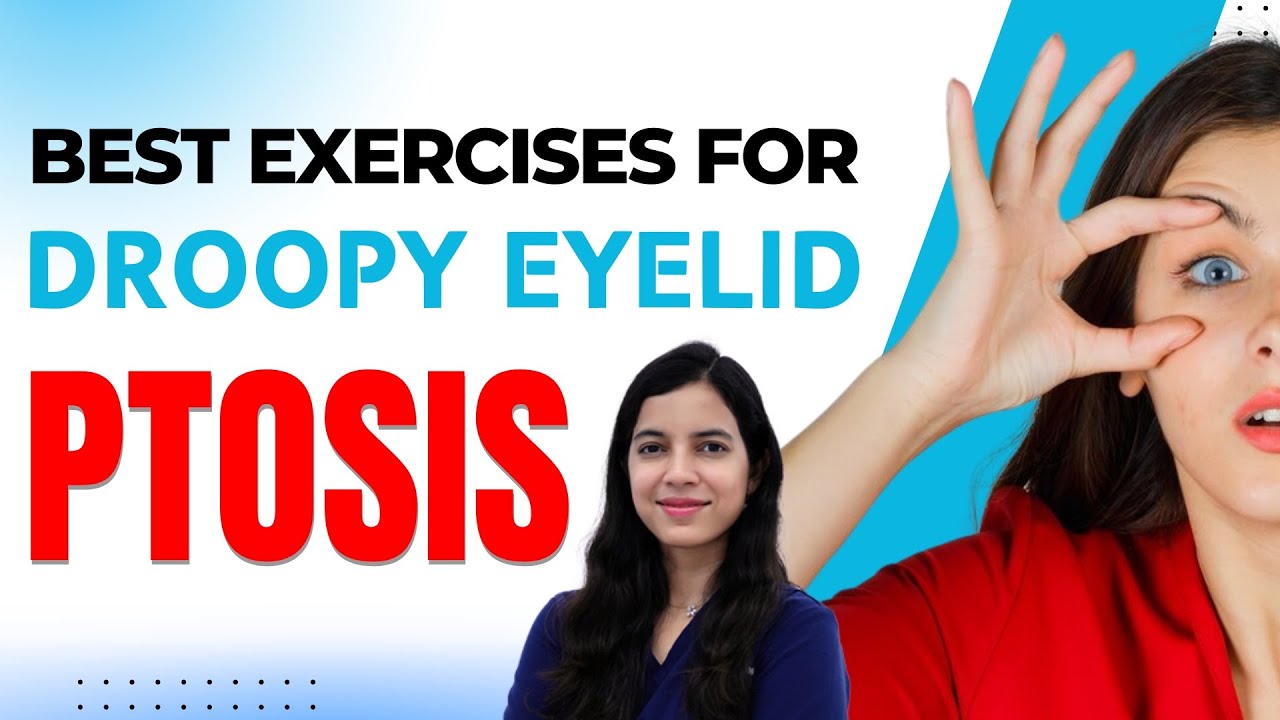 Best exercises for droopy eyelid ptosis, explained by an eye plastic ...