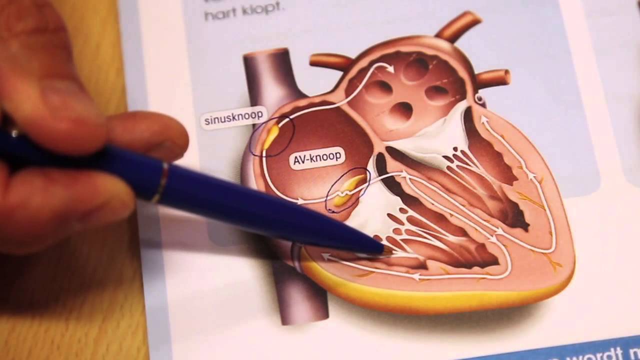 Atriumfibrilleren - Ziekenhuis Gelderse Vallei - YouTube