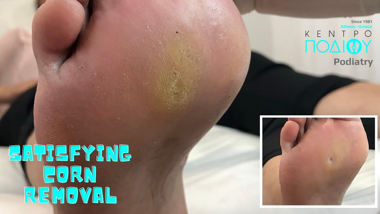 CORN TREATMENT|Αφαίρεση τύλου|Κέντρο Ποδιού Podiatry|Ποδιατρική ...