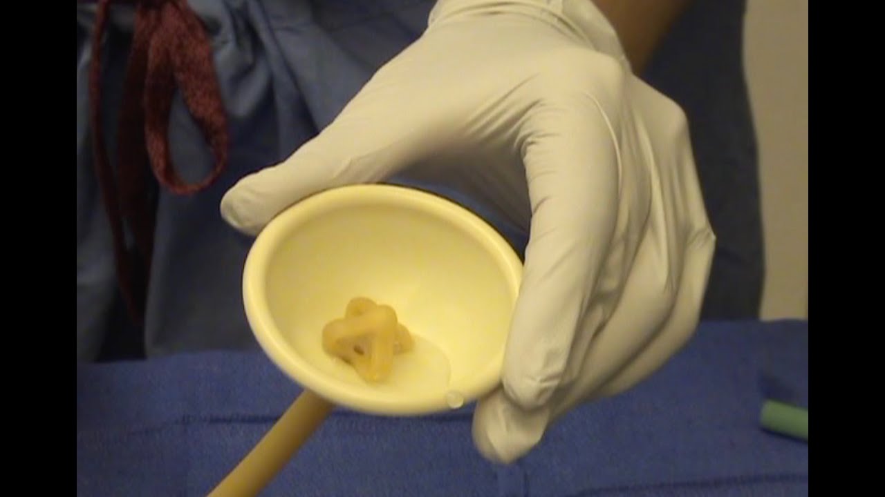 Vesicovaginal Fistula Catheter - YouTube