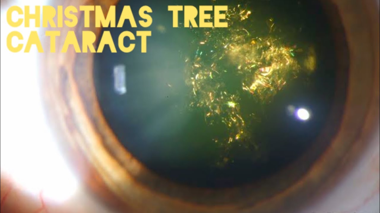 #High yield Neetpg - CHRISTMAS TREE CATARACT. - YouTube