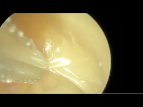 1,629 - Candida Ear Infection Removal — Including Off the Eardrum (Part ...