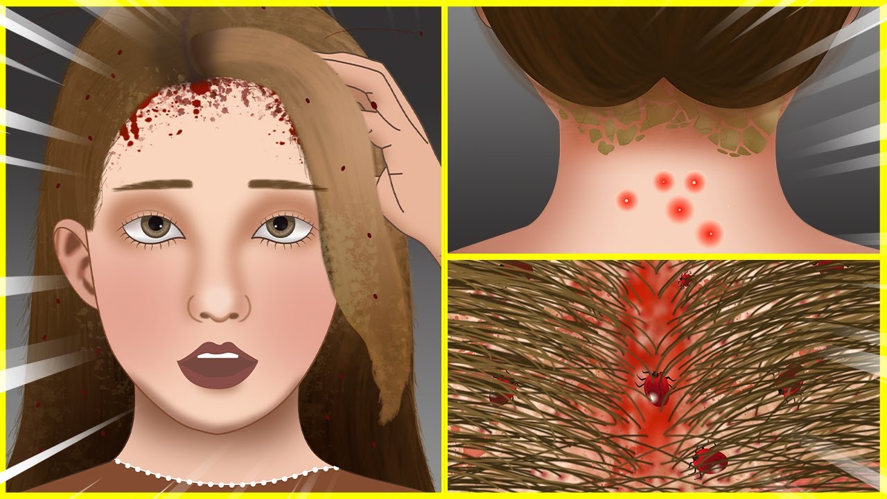 ASMR Treatment of Head Lice and Scabies Removal | Satisfying Scalp ...