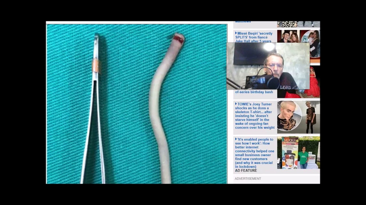 BREAKING! Baby Born With Tail In Brazil - YouTube