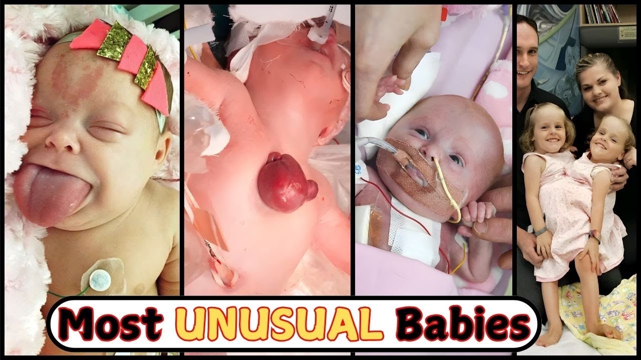 Extraordinary Babies Born Different – Incredible Survival Stories ...