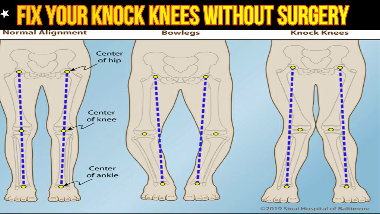 Treat Knock Knees With Easy Exercise And Stretches Youtube