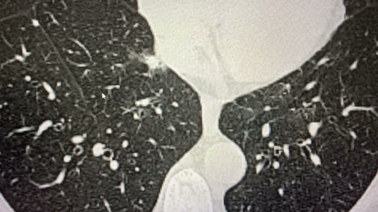Halo sign : Nodule with ground glass background: Hemorrhagic Mets ...