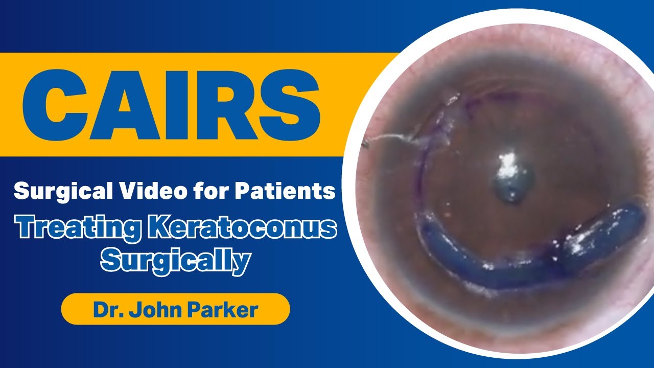 CAIRS Surgical Video for Patients - Treating Keratoconus - YouTube