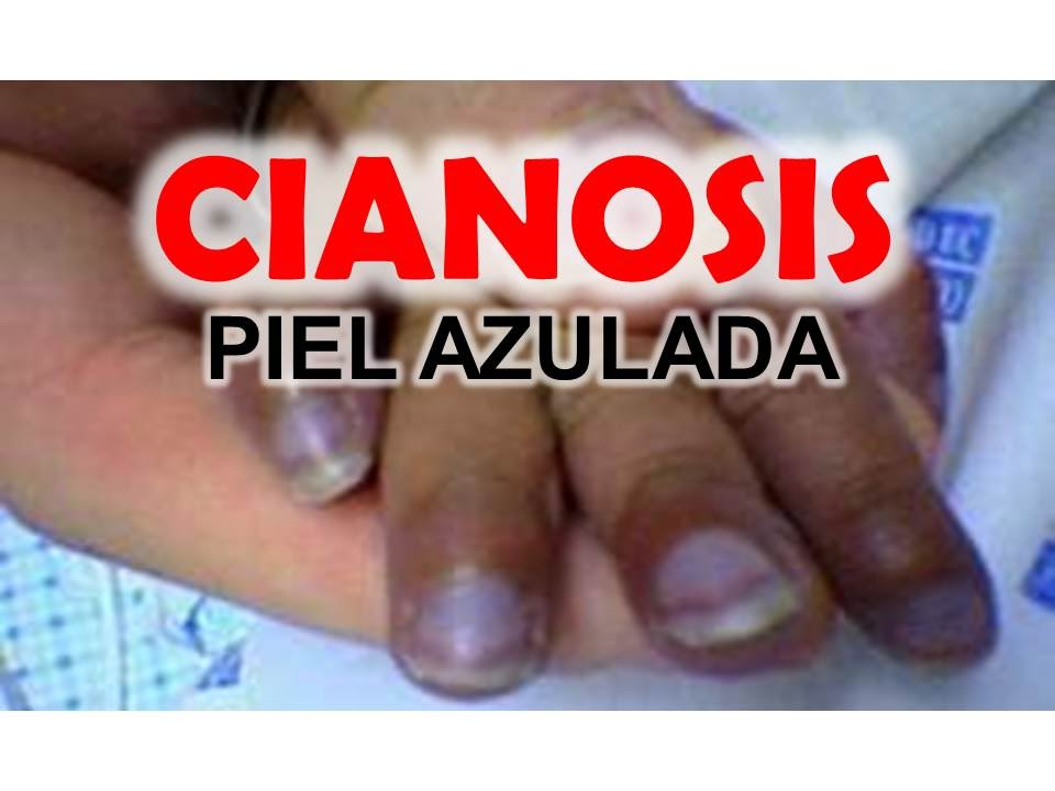 Que Es Cianosis Su Definicion Y Significado 2021