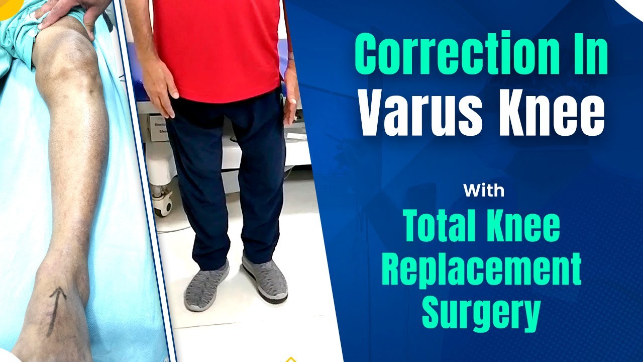 Deformity Correction in Varus Knee with Total Knee Replacement Surgery ...