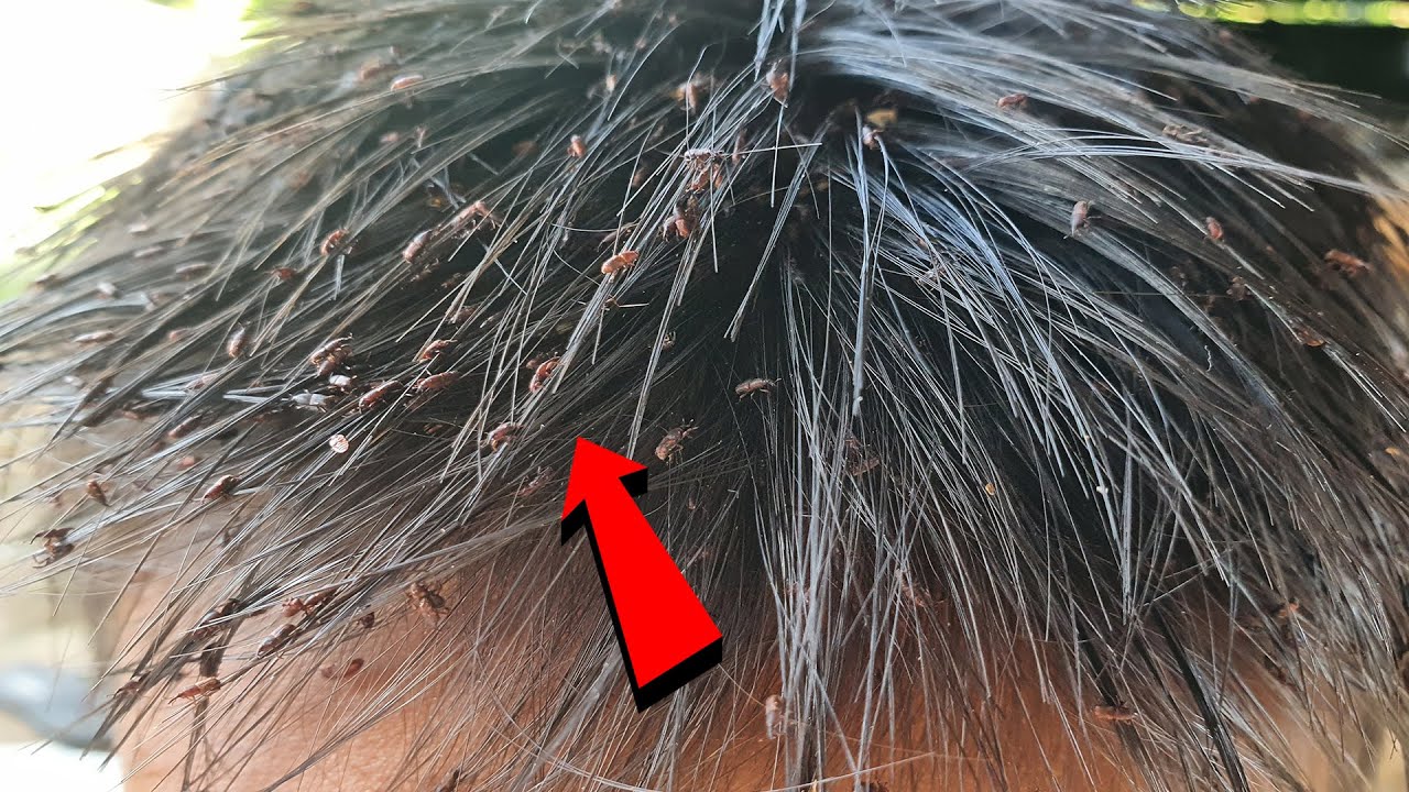 Extreme Head lice removal - Big lice combing - YouTube