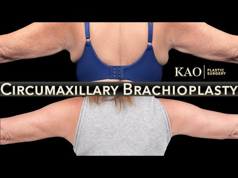 KAO Plastic Surgery Arm Lift Without The Huge Scars - Circumaxillary Brachioplasty - Arm Tightening