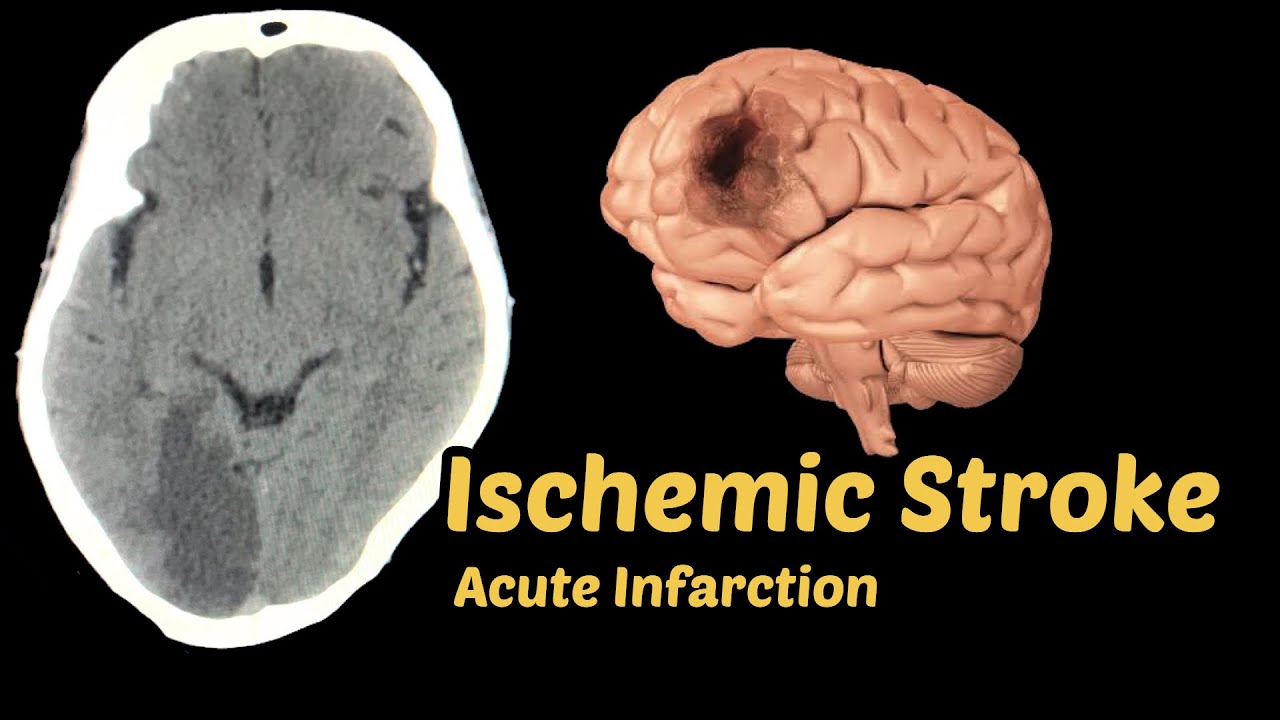Ischemic Stoke : Acute Infarction Ct Brain | Radiology - YouTube