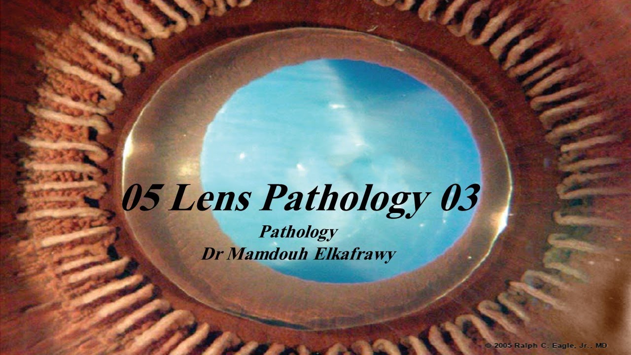 05 Lens Pathology 03 #Elkafrawy #pathology #باثولوجي#الكفراوي (Postior ...