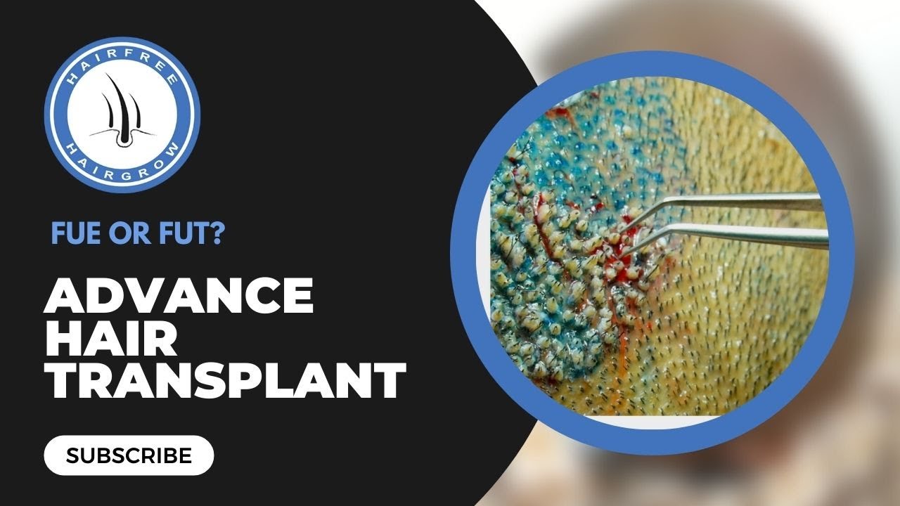 Advanced Hair Transplant Techniques | FUE or FUT what is Best ...
