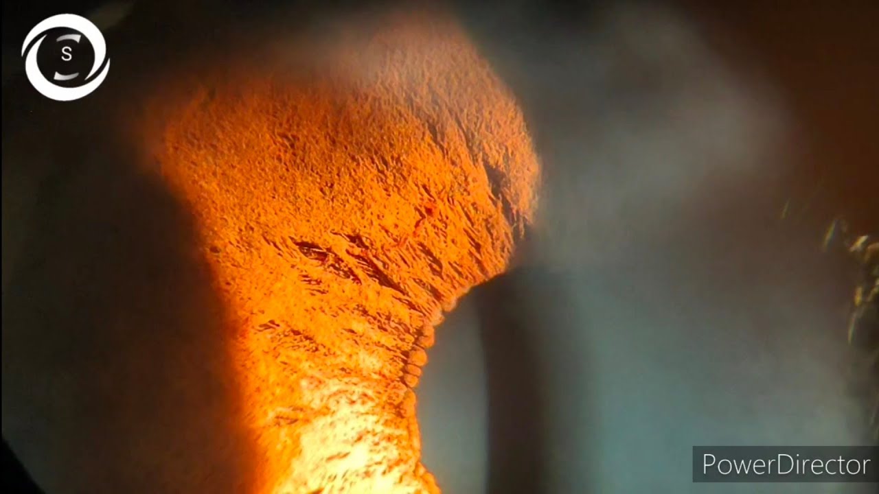 how to differentiate between normal and abnormal iris vessels - YouTube