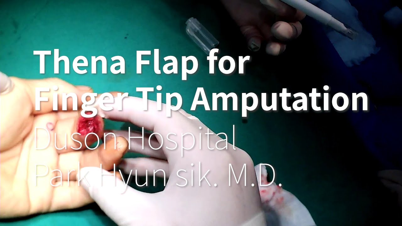 Thena flap for finger tip amputation - YouTube