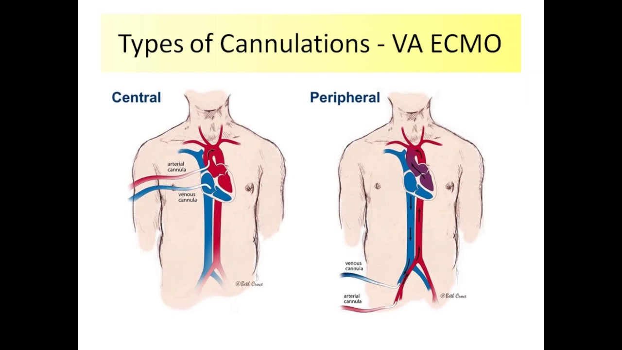 ECMO INDIA 2017, Training Program June 1-4, RVMH, Mumbai - Day 3 - Lecture 07 Dr. Vivek Gupta ...
