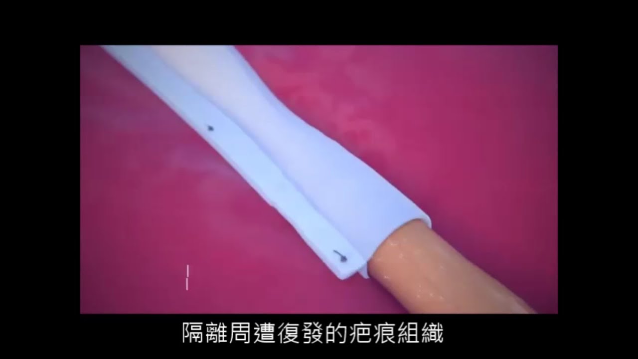 Axoguard Nerve Protector 神經保護膜 - YouTube