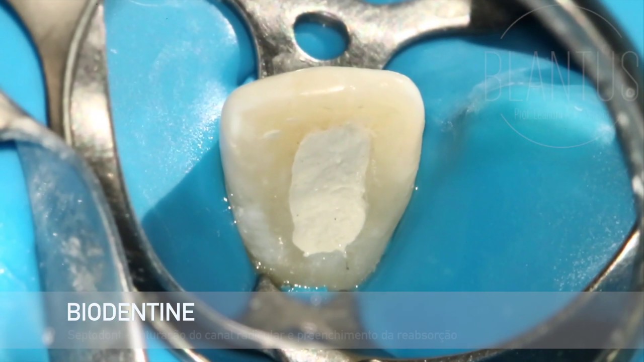 Biodentine - YouTube