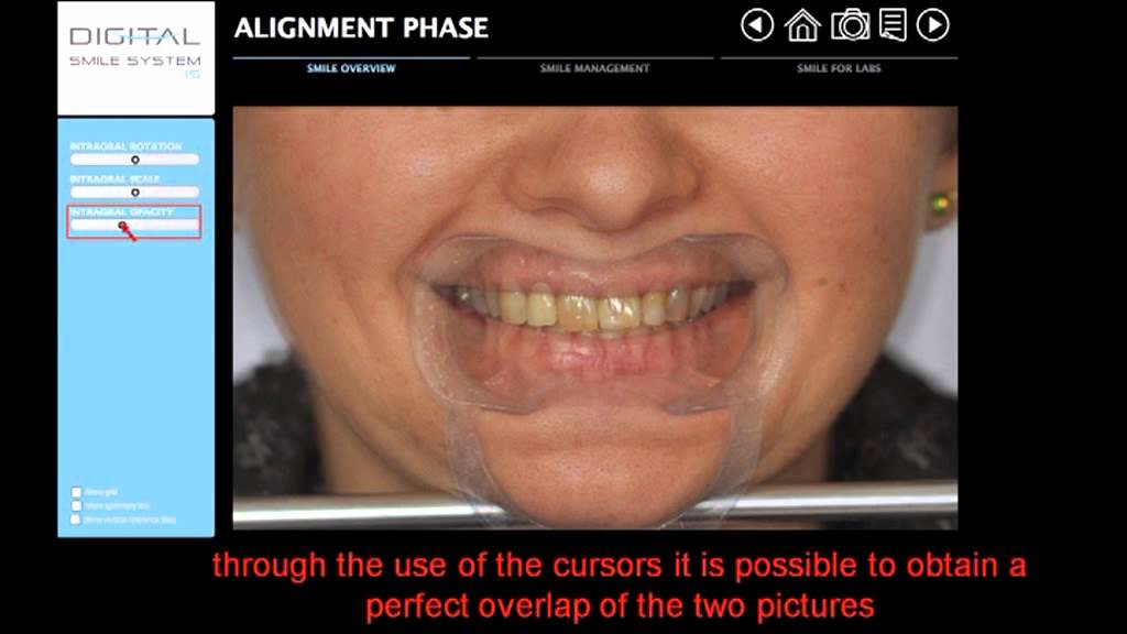 Digital Smile System (DSS) - tutorial English - YouTube