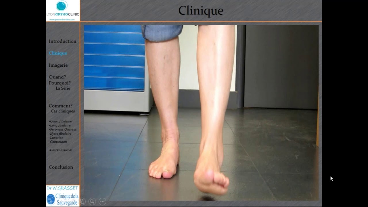 Dr W GRASSET La chirurgie des tendinopathies des fibulaires - YouTube