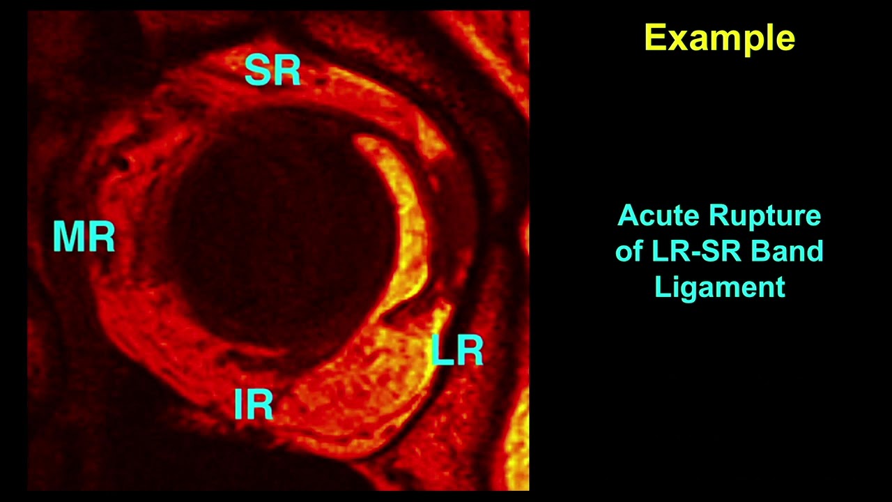 PED08 07 Section VI Break on Through New Innovations in Strabismus ...