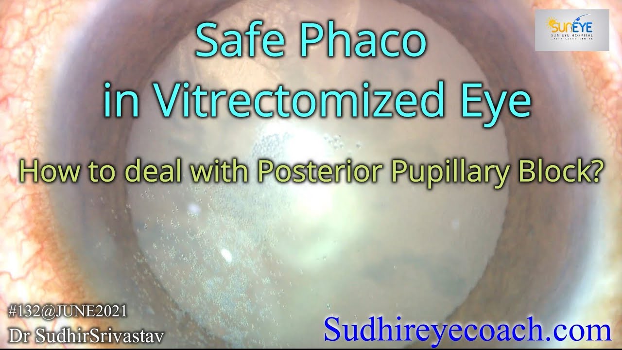 Phaco in Silicon oil-filled Vitrectomized Eye -How to deal with ...