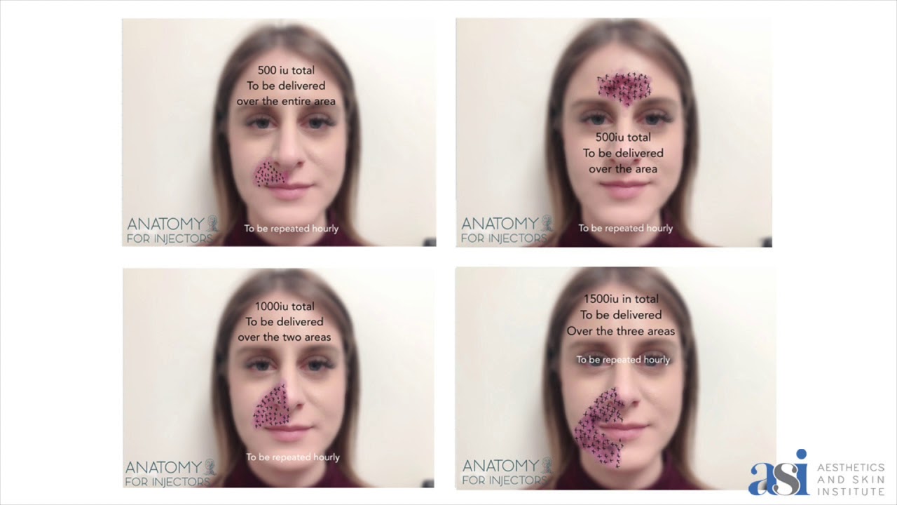 Hyaluronidase Protocol - YouTube