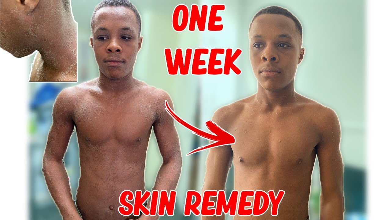 HOW TO CLEAR ECZEMA ACNE PSORIASIS IN A WEEK | SKIN TRANSFORMATION ...
