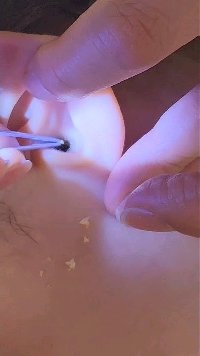 귀지 제거 2 아기 귀지 제거 Ear Cleaning 耳掃除 Shorts 귀지 Earwaxremoval