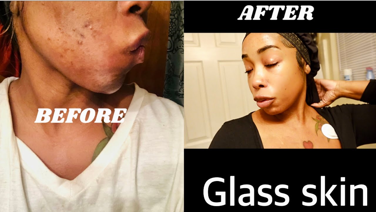 HOW I CLEARED MY ACNE IN 2 WEEKS!! GLASS SKIN!!! NO MORE ACNE OR ...