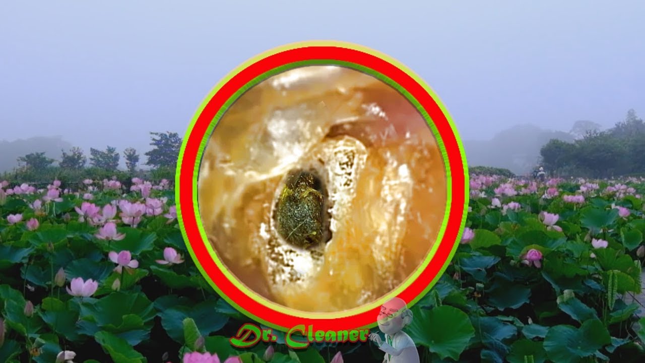 Massive Rock -Hard Earwax Removal From girl's ear | Nasty ear wax ...