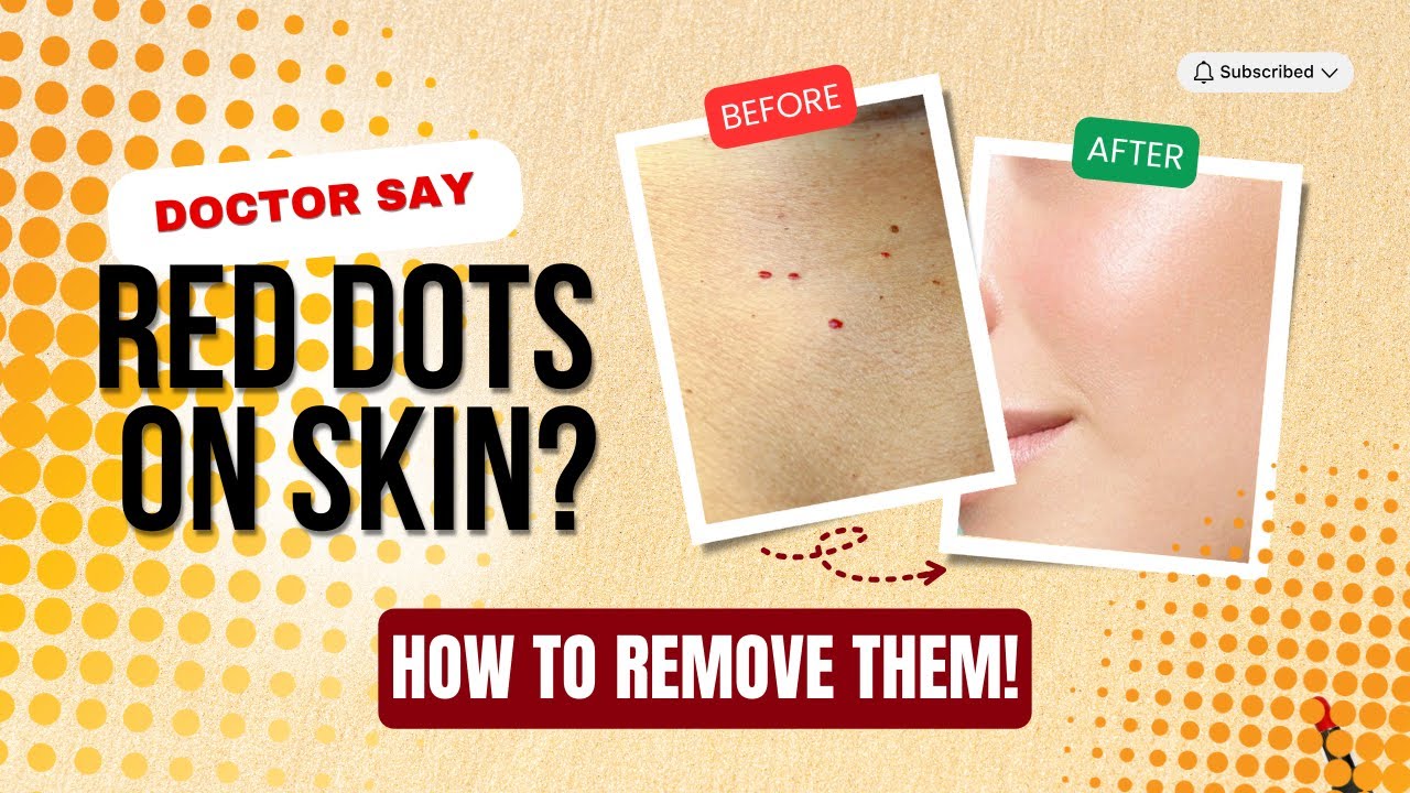 What is a Cherry Angioma? Causes, Treatment & Safe Removal Tips ...