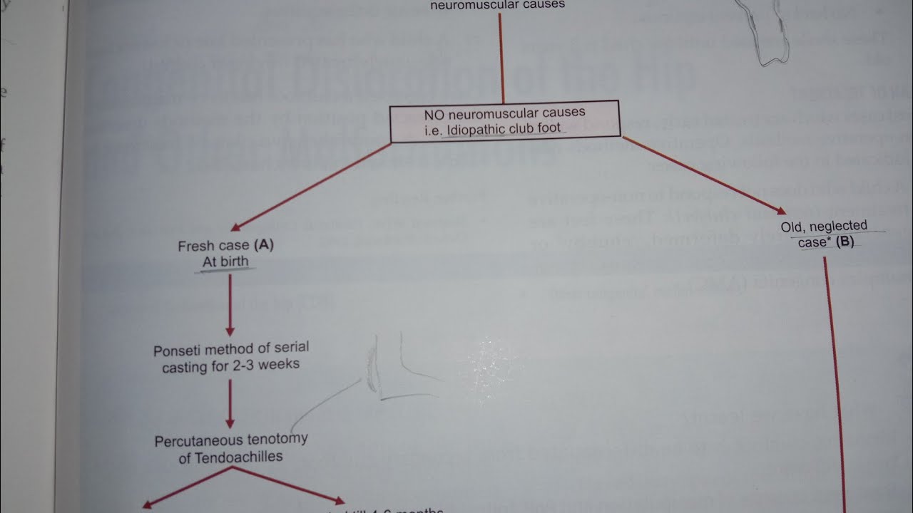 CTEV part-3 || Treatment plan for CTEV - YouTube