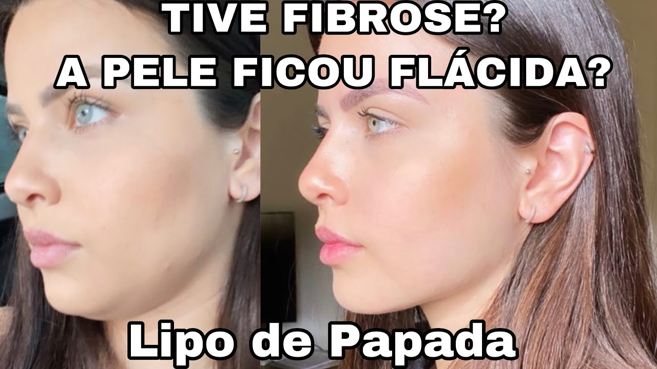 LlPO DE PAPADA: Pele flácida, fibrose, cicatriz, sensibilidade da pele ...