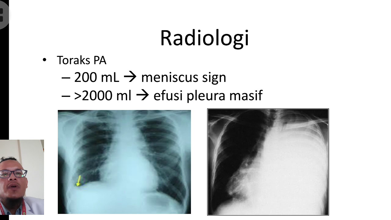 Efusi Pleura - YouTube