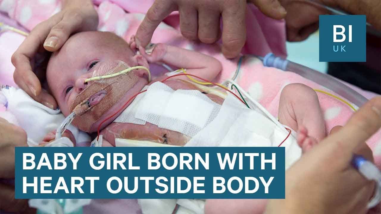 Baby born with heart outside her body becomes first UK child to survive ...