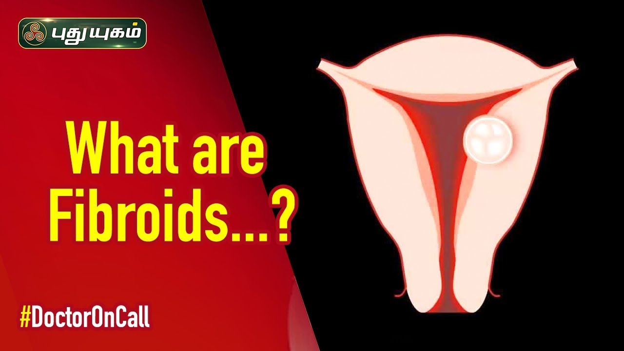 கர்ப்பப்பை கட்டிகளா? | What are Fibroids? What causes uterine fibroids ...