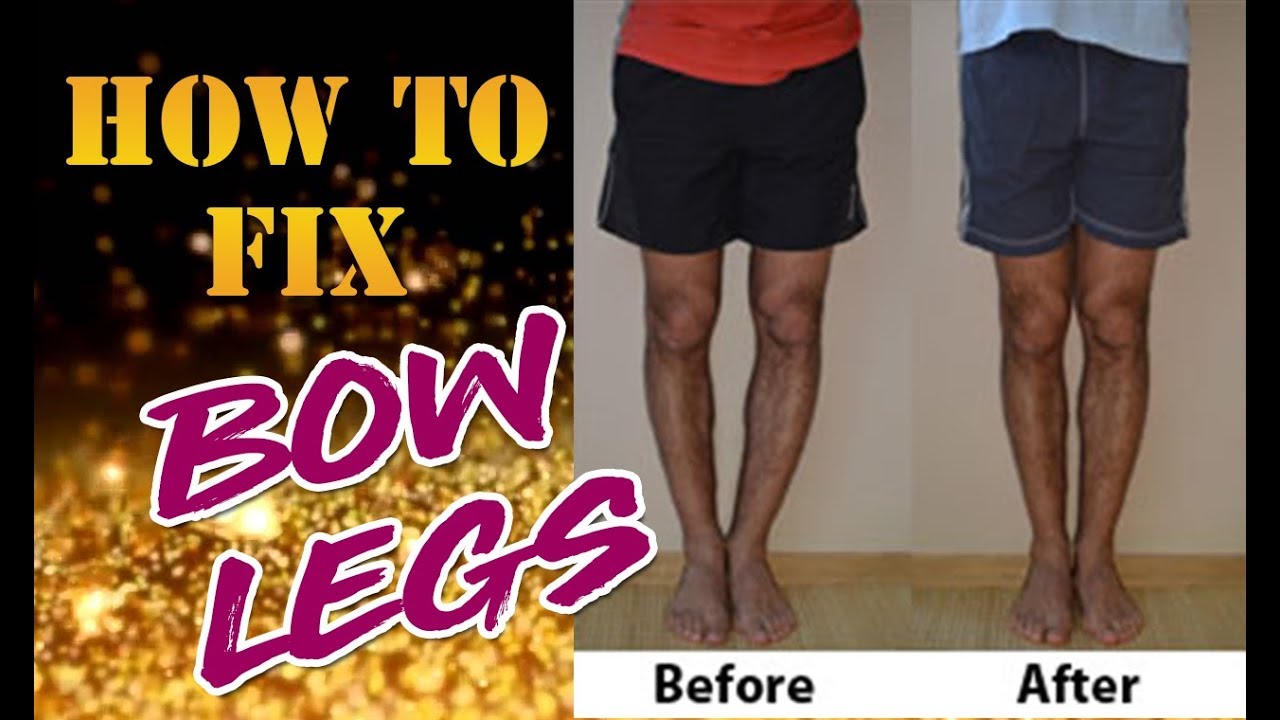 How to fix bow legs - best result for How to fix bow legs - YouTube