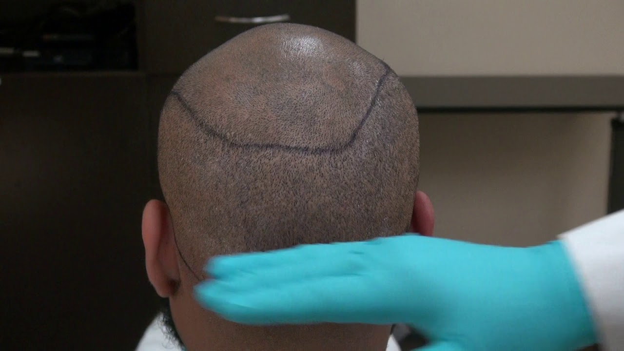 FUE Scar 1 Year After Dr. Diep Hair Transplant Surgery Follicular Unit ...