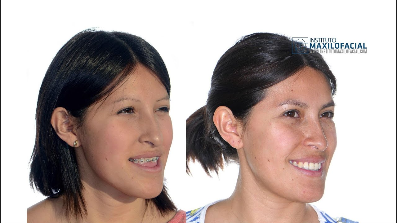 Bimaxillary orthognathic surgery. Case # 56: Noemi - Class 3, open bite ...